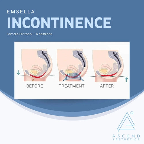 Emsella Treatment -(Incontinence Treatment Protocol Women)